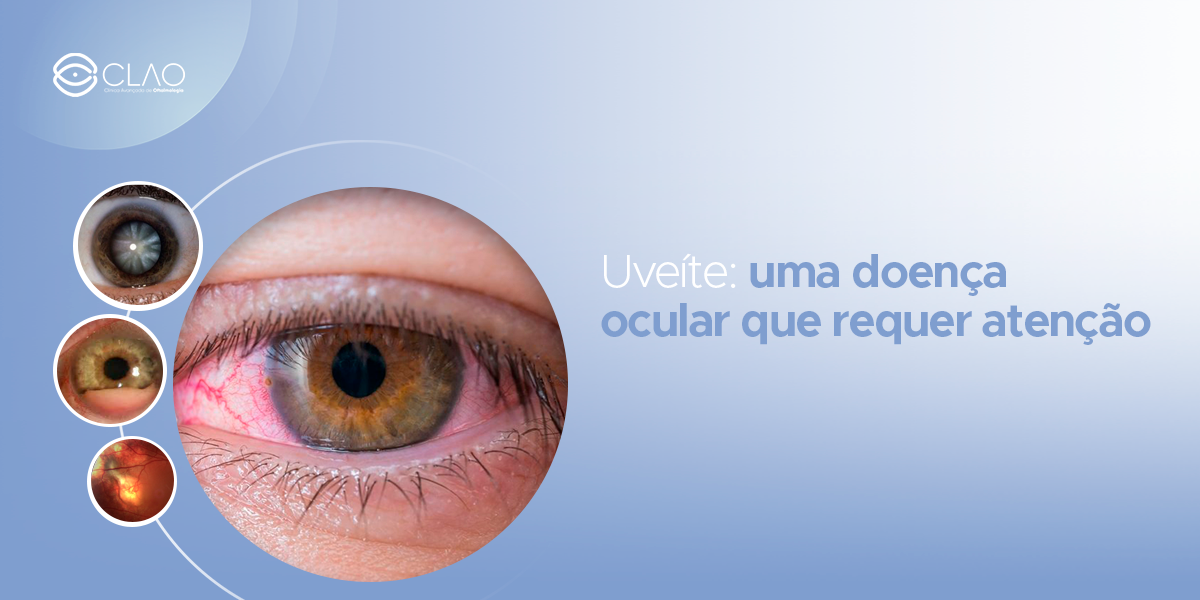 Uveíte: uma doença ocular que requer atenção - CLAO Medicina Integrada